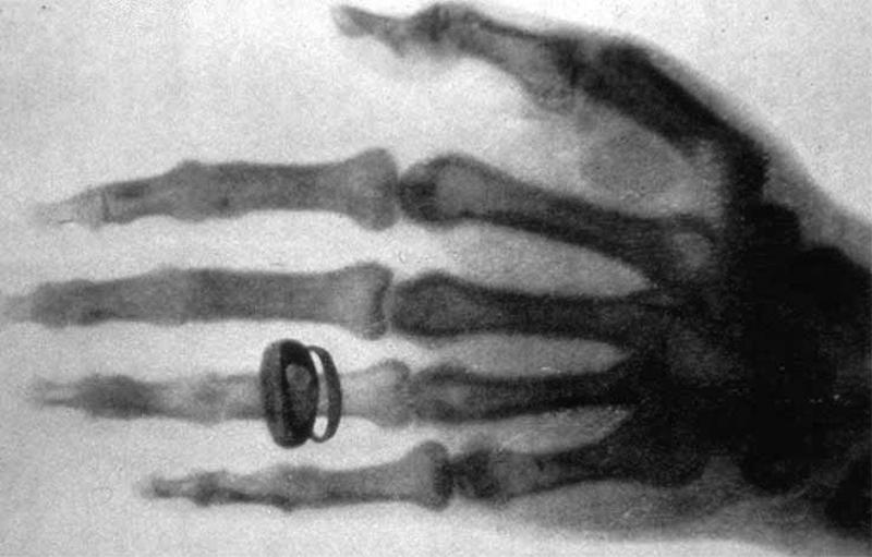 X-rays Were a Life-Saving Accident